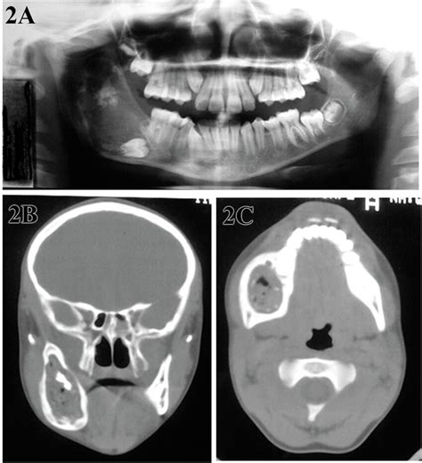 Panoramic Radiograph Showing A Well Defined Multilocular Radiolucent Download Scientific