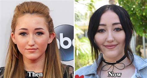 Noah Cyrus Plastic Surgery Before And After Photos Latest Plastic Surgery Gossip And News