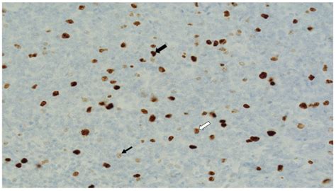 Diverticulitis And Colon Cancer