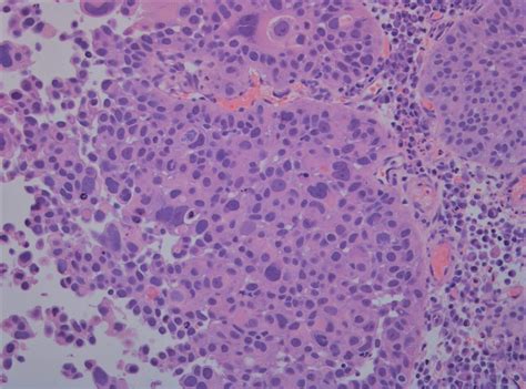 Pathology Outlines Grading Bladder