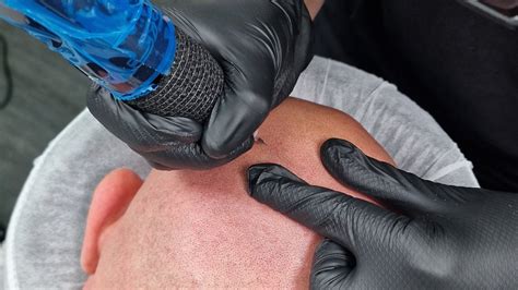 What Is Scalp Micropigmentation Scalp Styles Uk