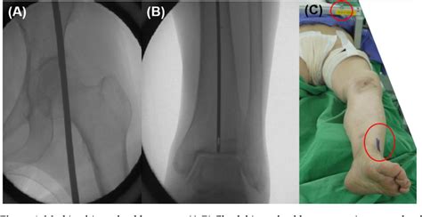 Figure 1 From Accuracy Of The Tibial Component Alignment By Extramedullary System Using Simple