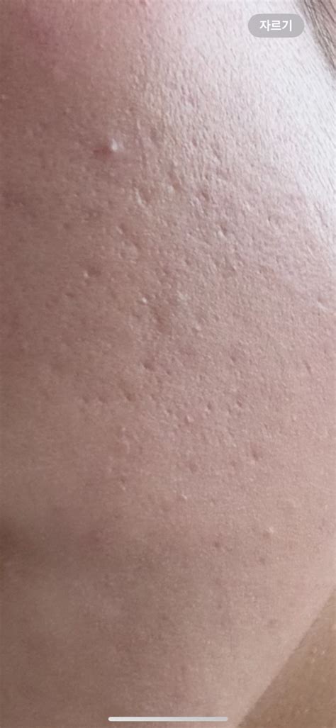 여드름 패인흉터 자가치료 가능할까요 지식in