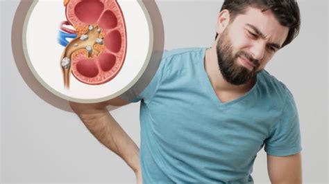 ឱសថនៅផ្ទះទាំង១០សំរាប់ជំងឺគ្រួសក្នុងតម្រងនោម ១