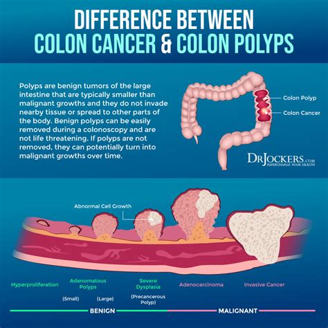 Stages Of Colon Polyps