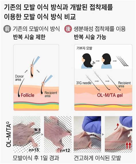 카이스트가 개발한 강력 접착제 모낭 없는 머리카락 심기 성공