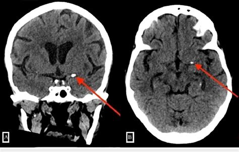 Nonenhanced Ct Of The Head Shows A Calcified Embolus Within The Left M1 Download Scientific