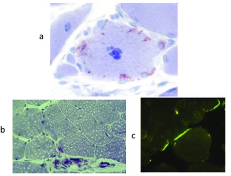 Amyloid Deposits Within Muscle Fibers In Ibm A [modified From [1]] Download Scientific