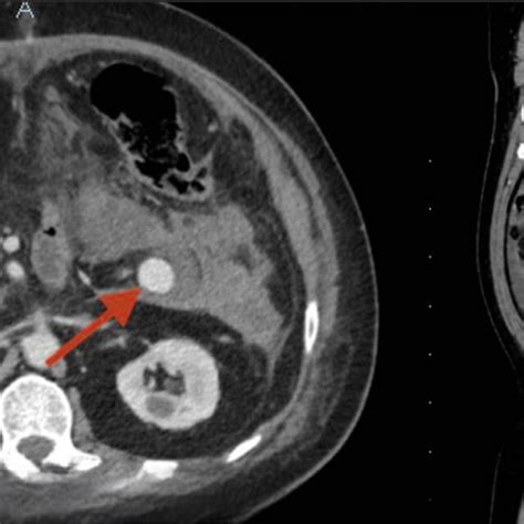 A Axial View Representing Pseudoaneurysm Of The Inferior Mesenteric Download Scientific