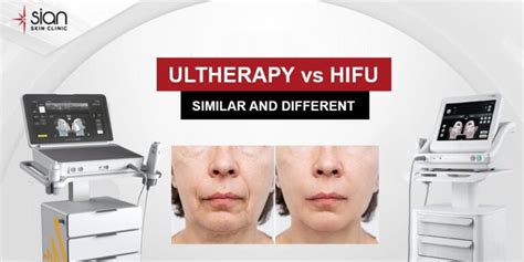 Ultherapy Vs Hifu Which Ultrasound Technology Is Better Sian Skin