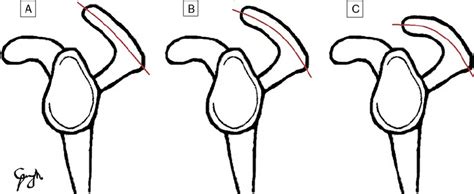 Acromion Fracture Classification