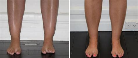 Calfankle Liposuction Sydney Gold Coast Canberra Adelaide