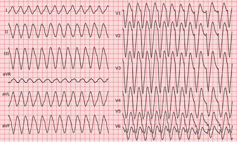 Cardio Fr Atrial Fibrillation Under Antiarrhythmic Treatment Class