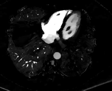 244lu Pulmonary Embolus Pe Lobar Perfusion Defect Hamptons Hump