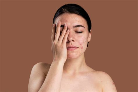 How To Get Rid Of Pimples On Face Causes Treatments And Prevention