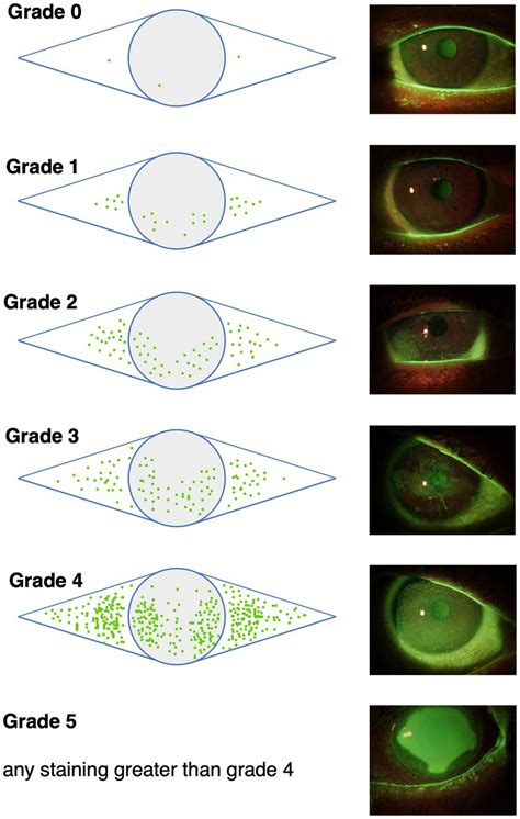 Frontiers Challenges And Concepts In The Diagnosis And Management Of Ocular Graft Versus Host
