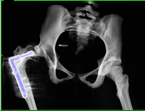 Hip Dysplasia Young Woman At Seth Rudall Blog