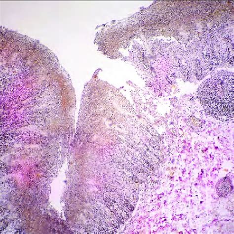 Pseudomembranous Colitis And Crohns Disease Ascending Colon With Download Scientific Diagram