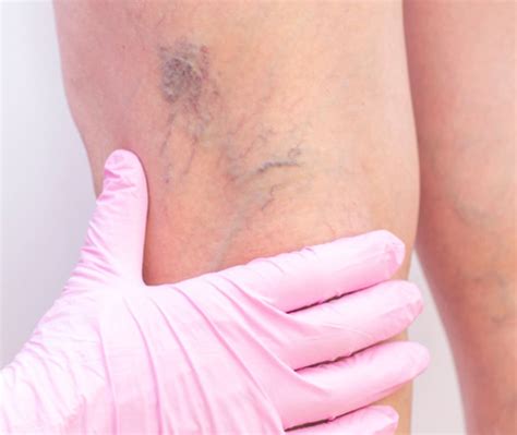 What Causes Broken Veins On The Legs Illuminate Skin Clinics