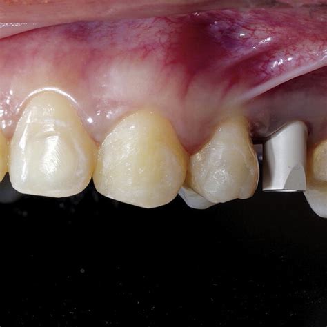 Scan Body Connected To Implant Body Download Scientific Diagram