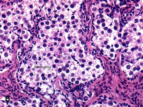 American Urological Association Gonadoblastoma