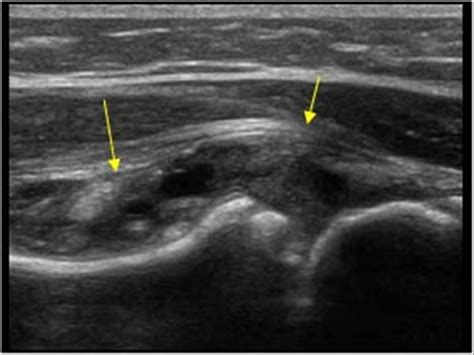 Musculoskeletal Joints And Tendons 6 2 Elbow Case 6 2 3 Arthritis Ultrasound Cases