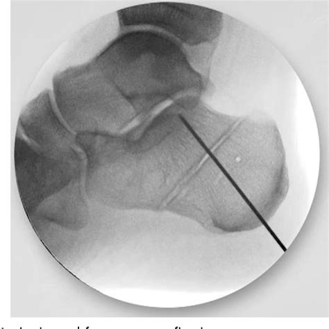 Figure 6 From Minimally Invasive Osteotomies Of The Calcaneus Semantic Scholar