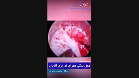 عمل تنگی مجرای ادراری آقایان نماشا