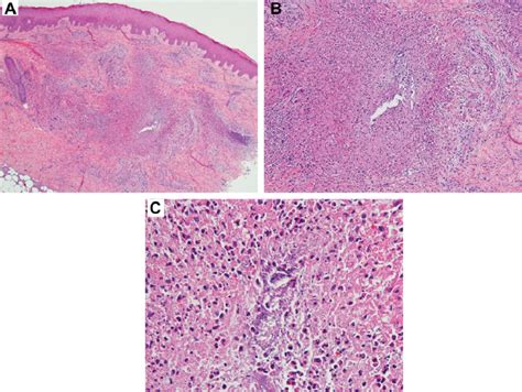 A Diffuse Dense Interstitial And Granulomatous Inflammatory Download Scientific Diagram
