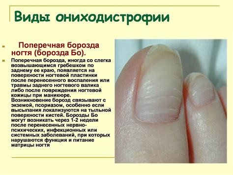 Поперечные борозды на ногтях причины (57 фото)