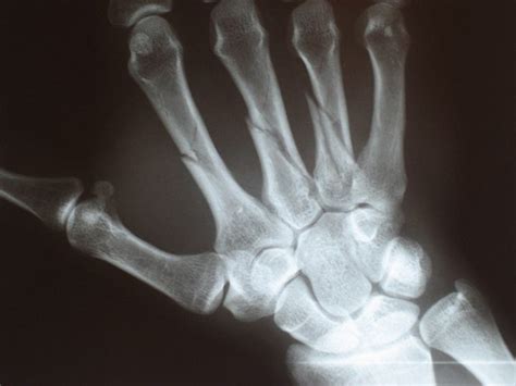 Metacarpal Fracture Buyxraysonline