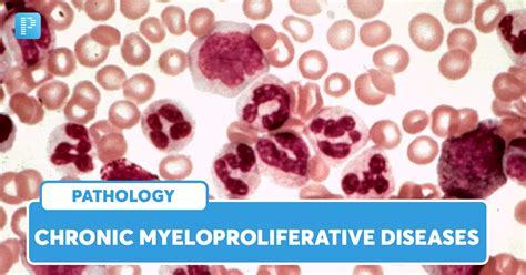 Chronic Myeloproliferative Disorders Clinical Features Types