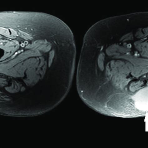 Axial T2 Weighted Mri Sequence Depicting A Homogenous High Signal Download Scientific Diagram