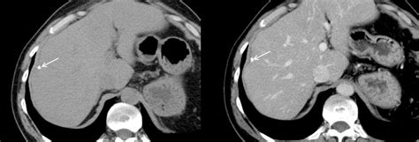Hepatic Granuloma A Peripheral Calcification Arrows In A Patient With