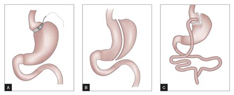 Racgp Bariatric Metabolic Surgery A Guide For The Primary Care Physician