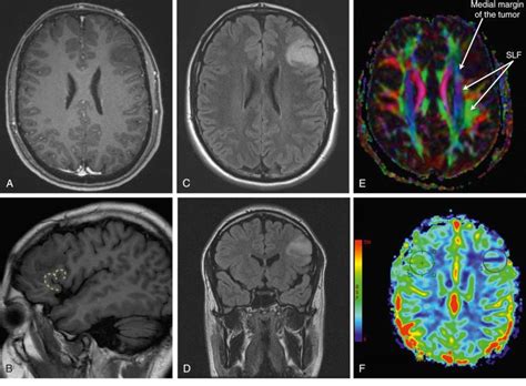 Awake Craniotomy And Speech Mapping For Gliomas Clinical Tree