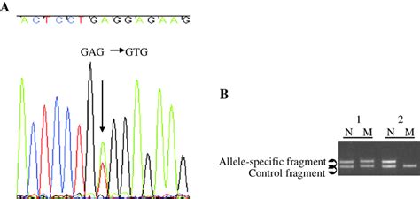 Detection Of The Molecular Defect Producing The Hbs Variant A Download Scientific Diagram
