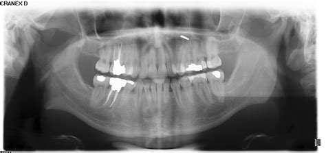 Infected Teeth Detecting Dataset And Pre Trained Model By Iaaa