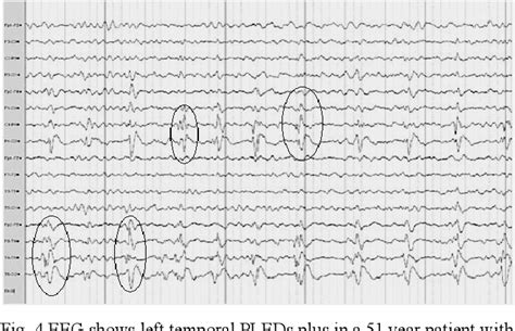 Figure 4 From Can Eeg Test Helps In Identifying Brain Tumor Semantic