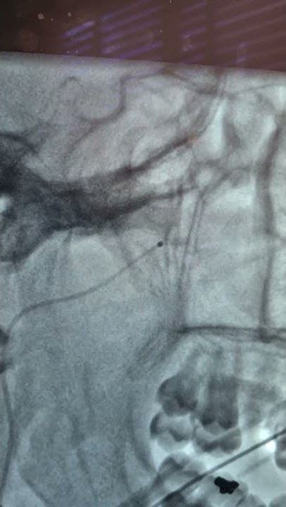 Epistaxis Embolizationrt Sphenopalatine Artery Embolization Youtube