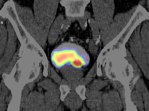 Enhanced Diagnostic Accuracy Of Tc Psma Spectct Vs Mpmri In Prostate