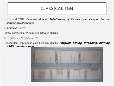 Trigeminal Neuralgia Pptx