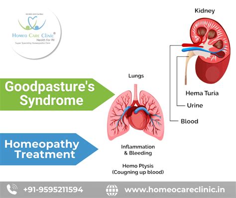 Goodpasture Syndrome Causes Symptoms And Natural Homeopathic Treatment