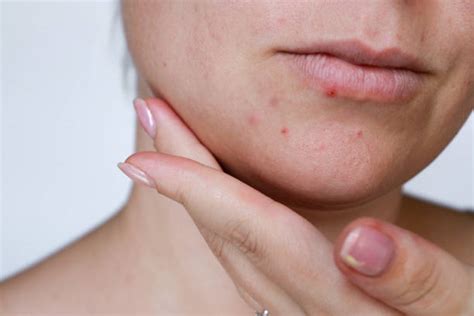 Cold Sore Vs Pimple Understanding The Differences And Similarities