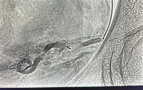 Fibroids The Vascular And Endovascular Clinic