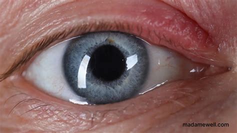 Seborrheic Dermatitis Of The Eyelids What Can You Do About It