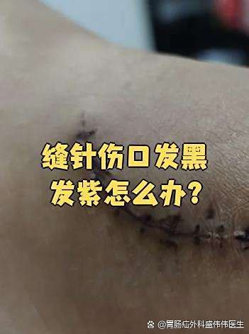 缝针伤口发黑发紫怎么办