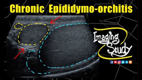 Chronic Epididymo Orchitis Ultrasound Case 328 Youtube