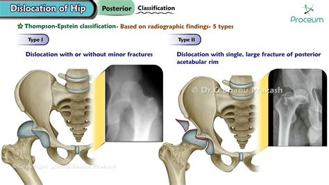Dislocation Of Hip Orthopedics Lecture Youtube