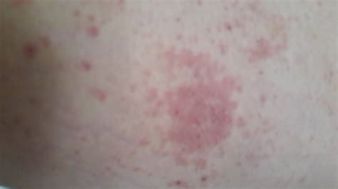 Staphylocoque Tattoos